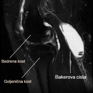 Što je Bakerova cista i kako je uspješno liječiti?